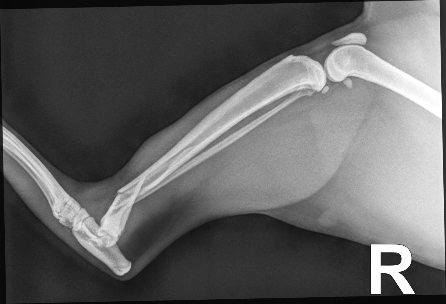 Rekonstrukcija in fiksacija zlomov kosti - emir