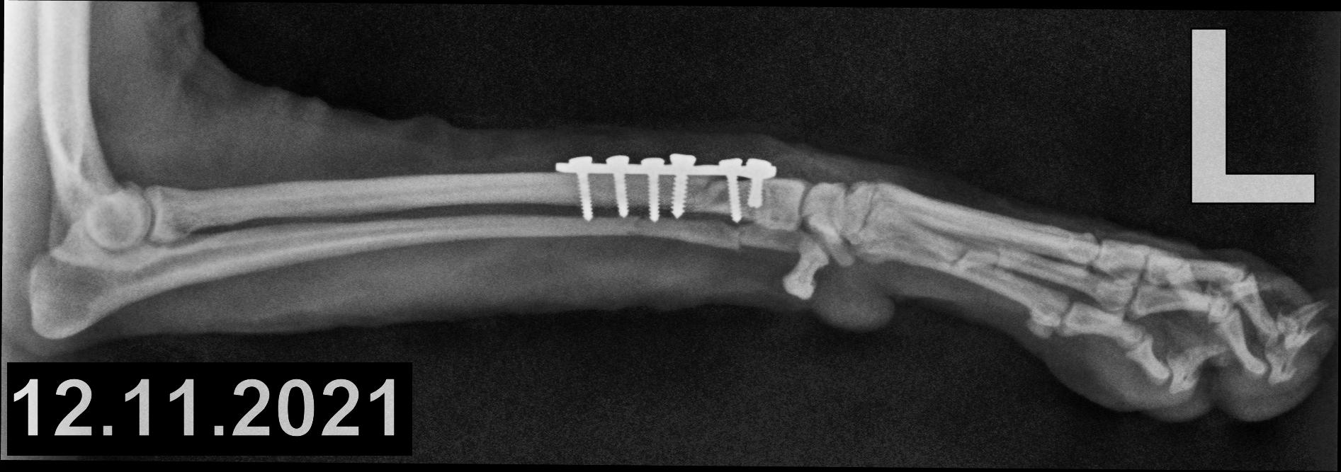 Rekonstrukcija in fiksacija zlomov kosti - emir