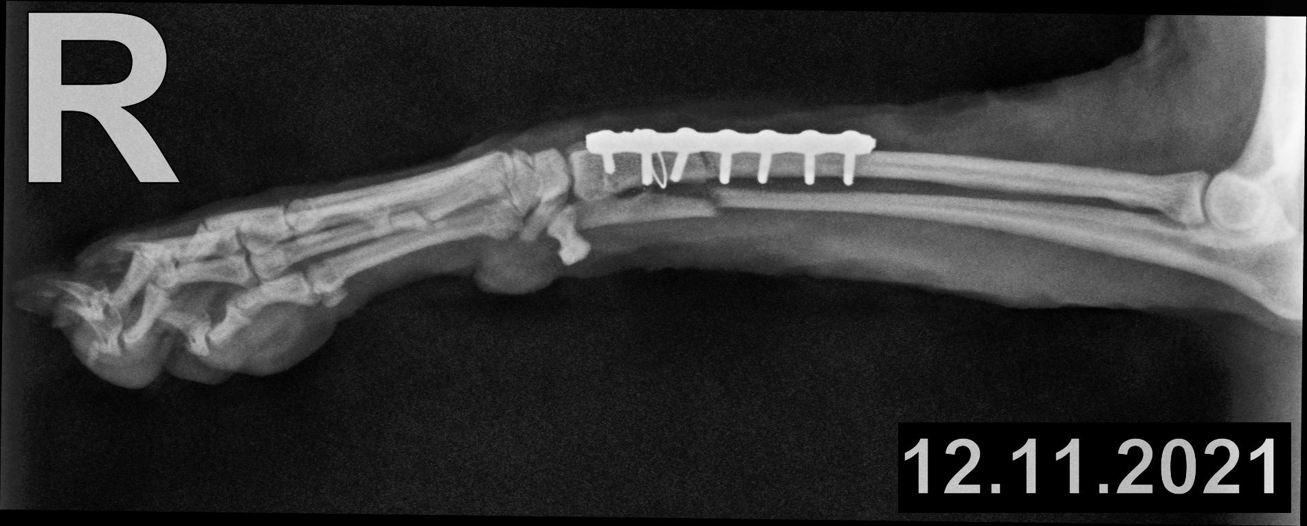 Rekonstrukcija in fiksacija zlomov kosti - emir