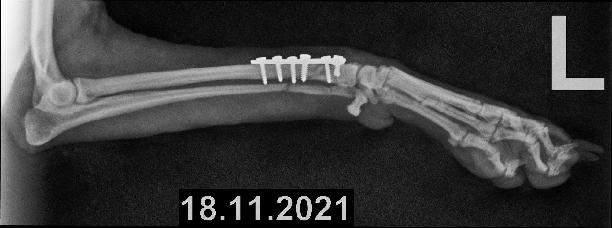 Rekonstrukcija in fiksacija zlomov kosti - emir