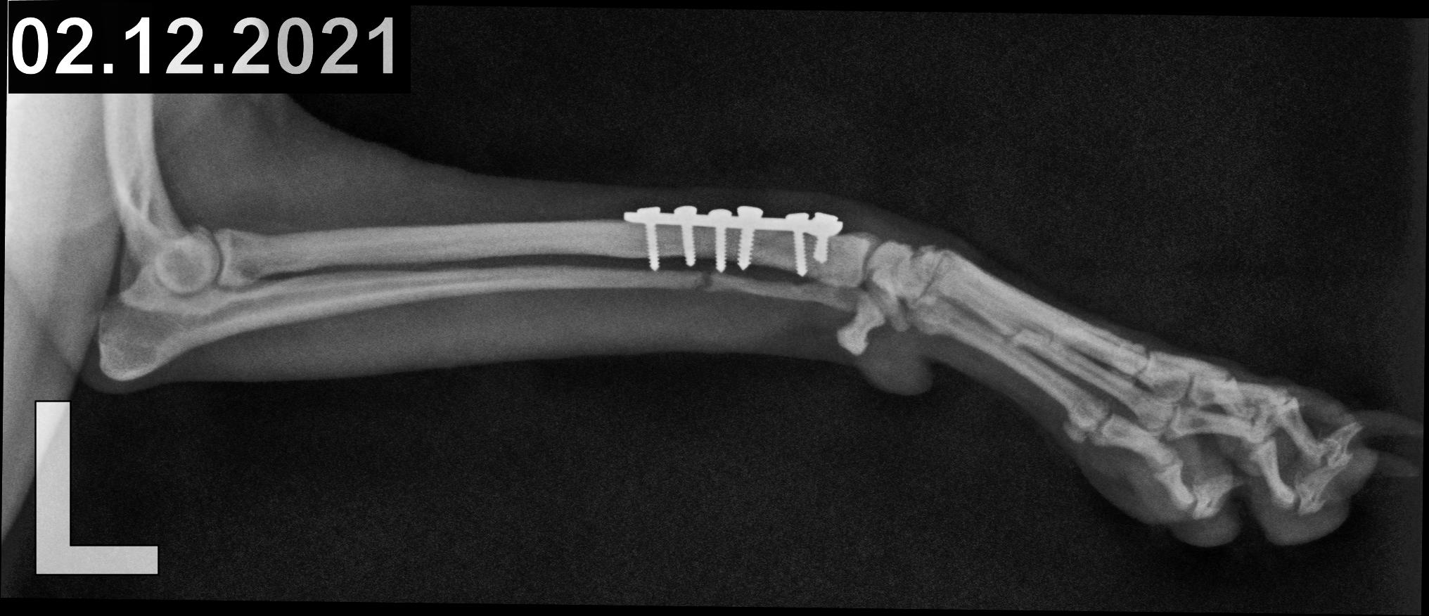 Rekonstrukcija in fiksacija zlomov kosti - emir
