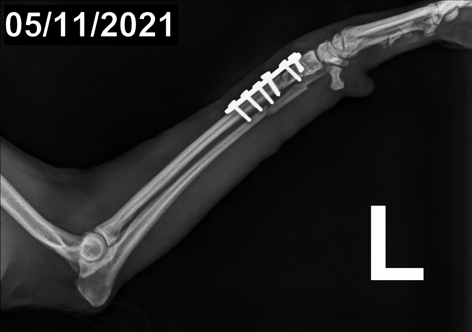 Rekonstrukcija in fiksacija zlomov kosti - emir
