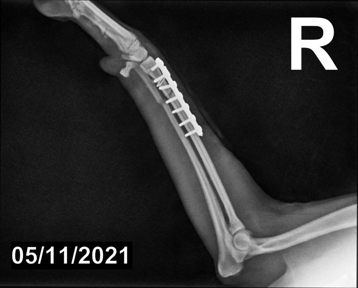 Rekonstrukcija in fiksacija zlomov kosti - emir